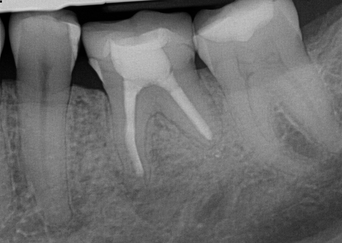 Endodontic Surgery- Jensen Endodontics Inc